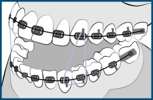 RPE Braces Treatment Steps - Cooney & Tyner Orthodontics