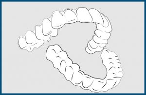 RPE Braces Treatment Steps - Cooney & Tyner Orthodontics