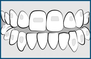 Class 3 Carriere Invisalign Treatment Steps - Cooney & Tyner Orthodontics